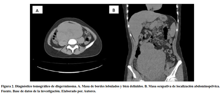 Ovario Tumor De Células Germinales