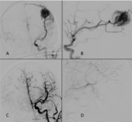 Experiencia de embolización de malformaciones arterio-venosas ...