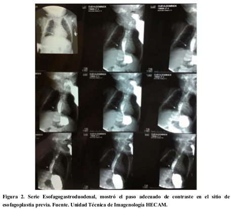 Tratamiento conservador del quilotórax posquirúrgico en paciente ...