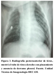 Tratamiento conservador del quilotórax posquirúrgico en paciente ...