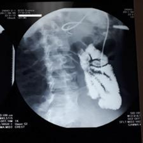 Intususcepción yeyuno duodenal, secundaria al uso de sonda Foley para ...