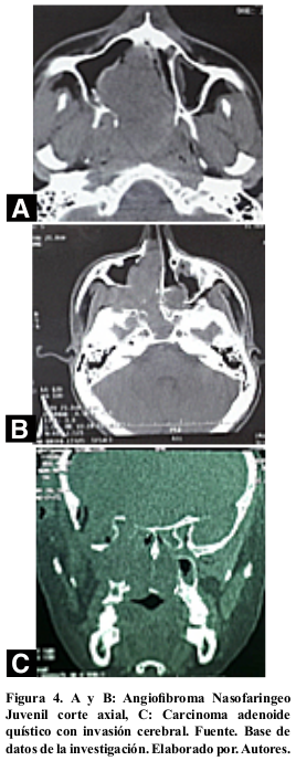 Tumores de Fosa Pterigopalatina: Tipos de abordajes quirúrgicos y ...